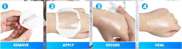 IV Cannula Dressing - jinyemed.com